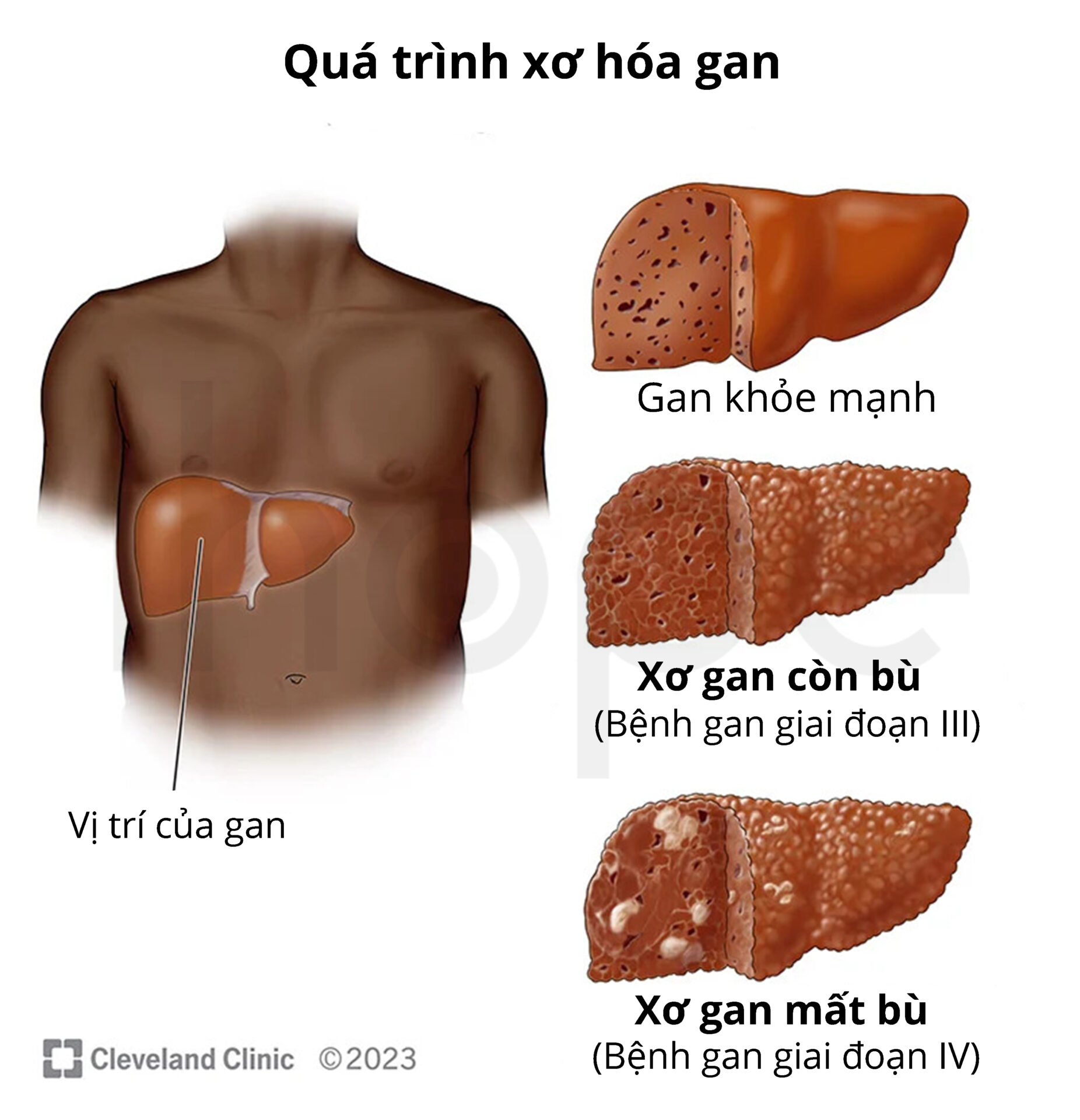 Nguyen Huyen Viem Gan